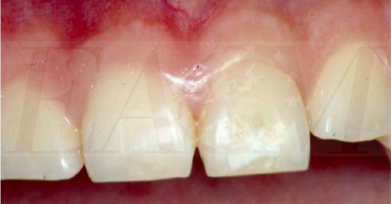 Tooth Erosion – European Association of Oral Medicine