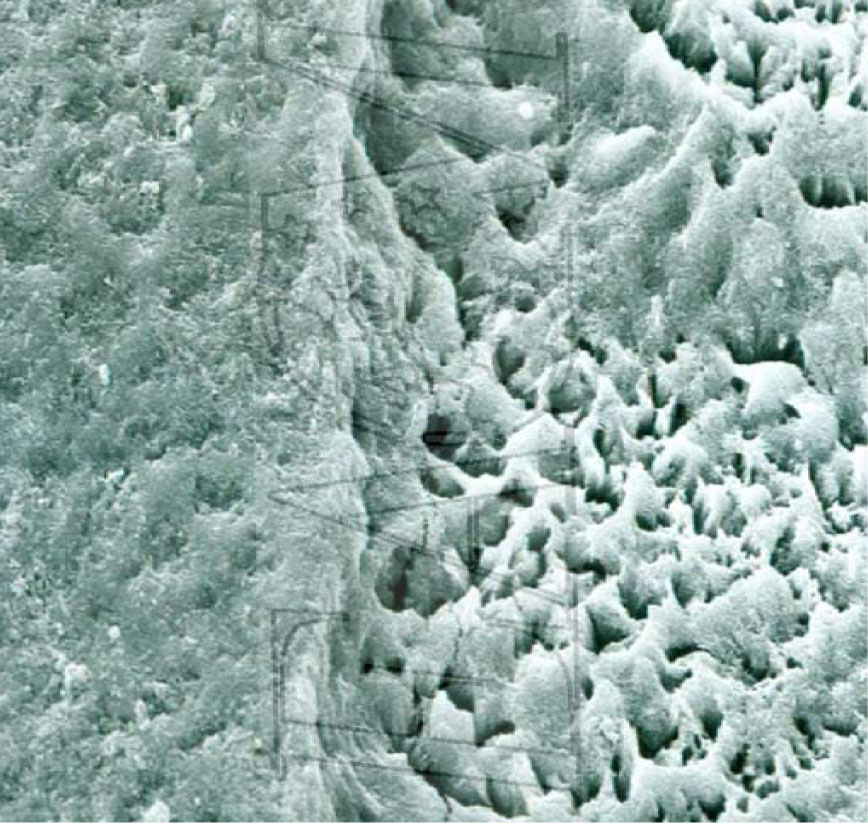 Tooth Erosion – European Association of Oral Medicine