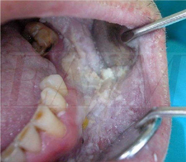 White Sponge Nevus – European Association of Oral Medicine