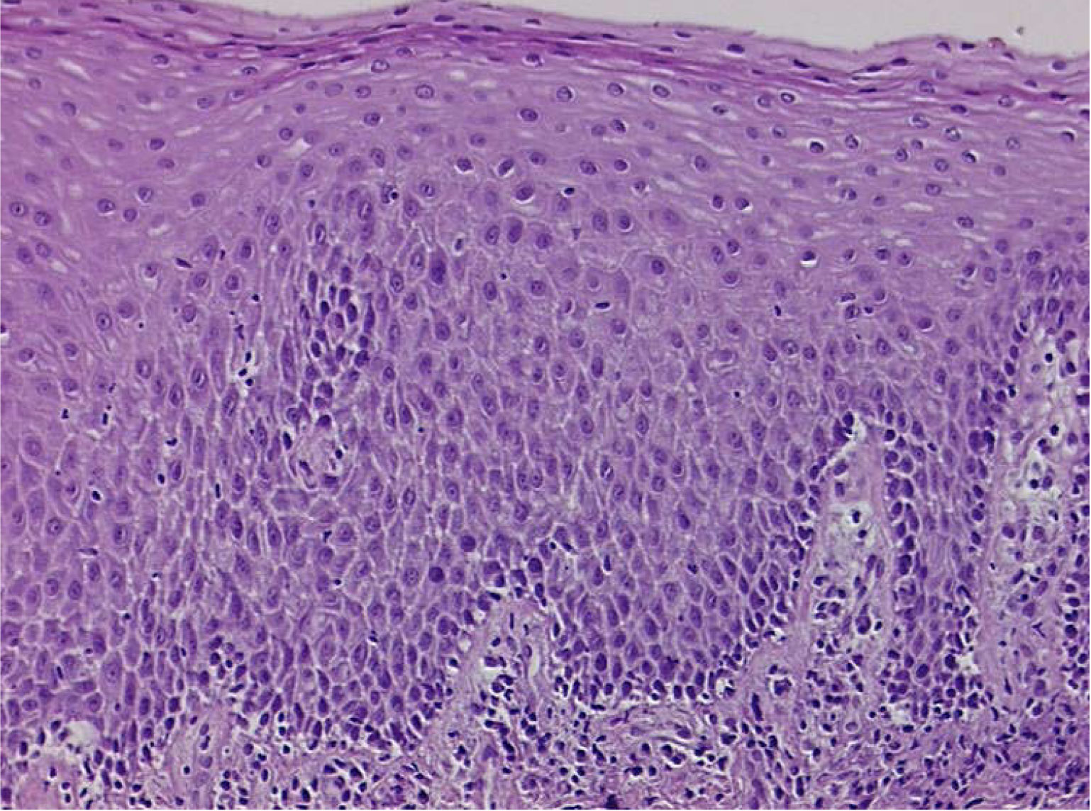 Graft Versus Host Disease European Association Of Oral Medicine