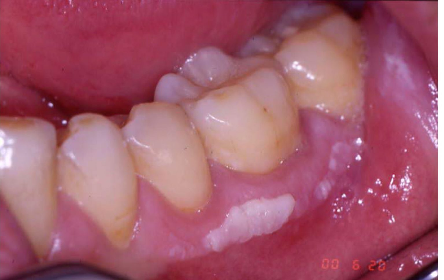 Leukoplakia – European Association of Oral Medicine