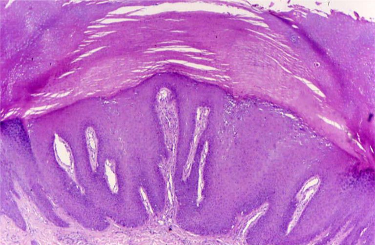 Leukoplakia – European Association of Oral Medicine
