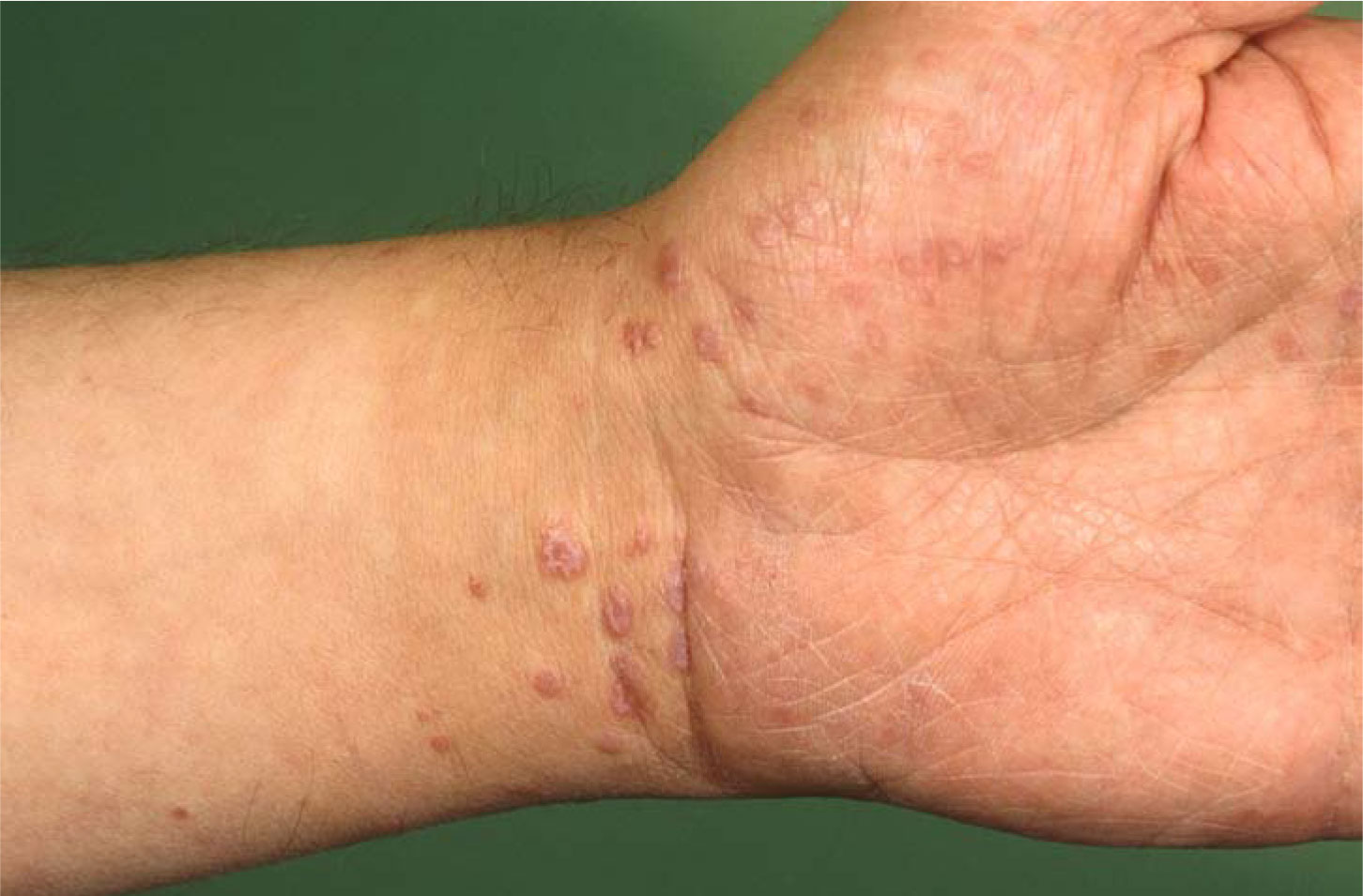 Oral Lichen Planus – European Association of Oral Medicine