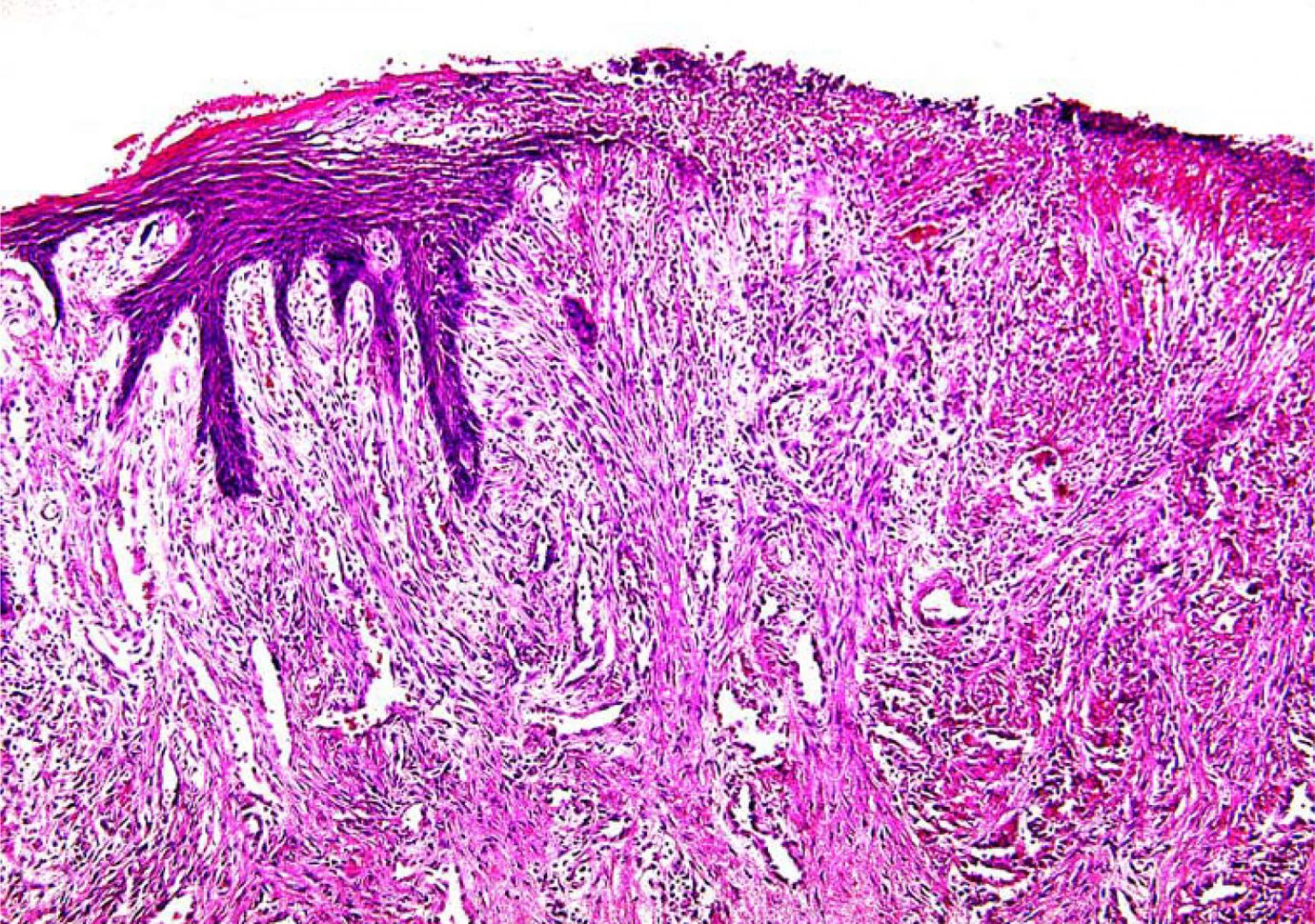 Pyogenic Granuloma – European Association of Oral Medicine